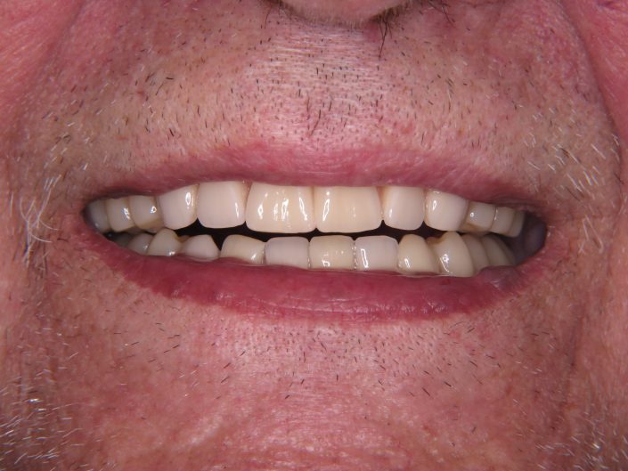 Kunstgebit – KIES Tandatelier