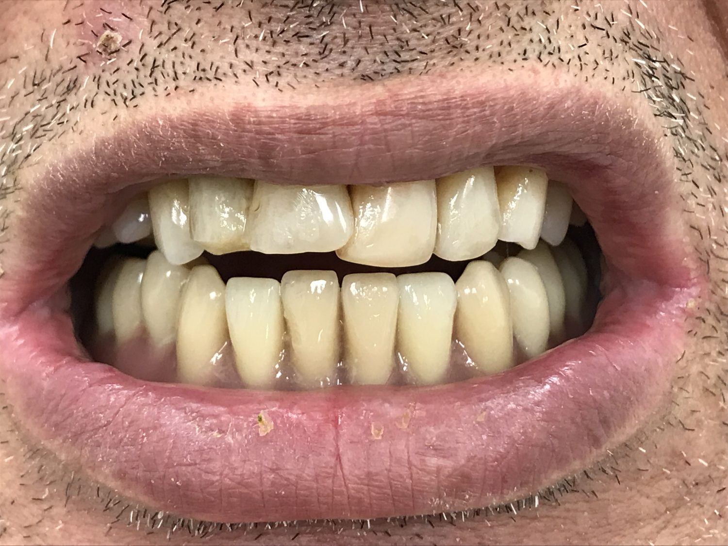 Kunstgebit – KIES Tandatelier